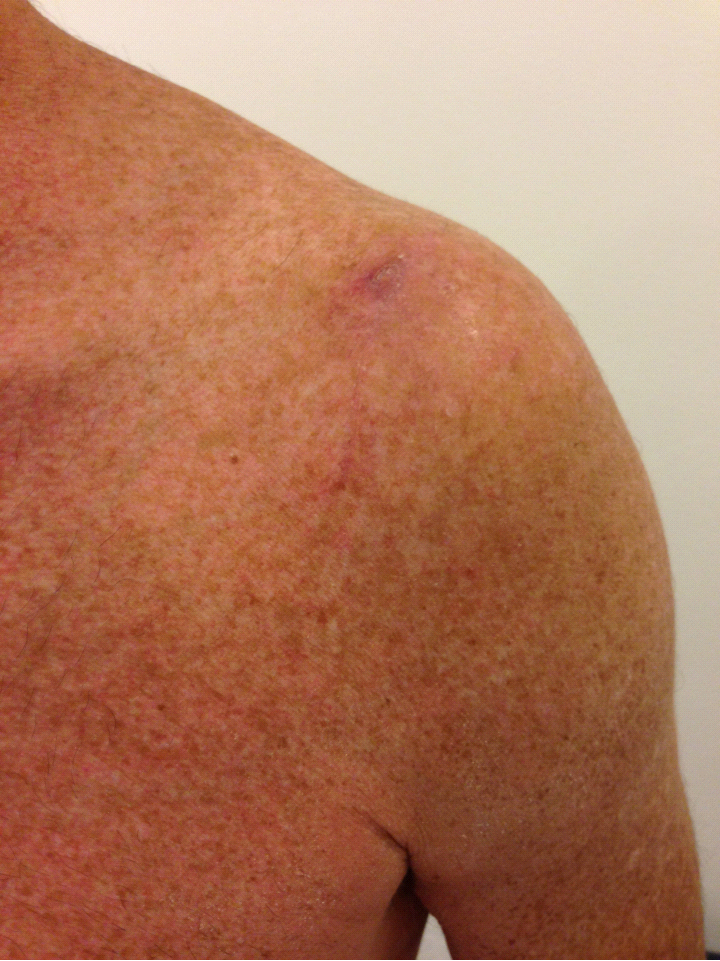 Shoulder Separation Repair - Murrell Orthopedics