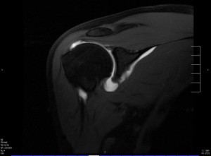 Rotator Cuff Repair - Murrell Orthopedics