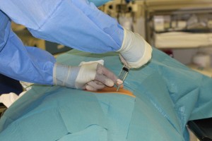 Bone Marrow Aspiration Concentration (BMAC) procedure (Collection of ...